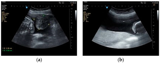 Uterine Fibroids and Pregnancy: A Review of the Challenges from a ...