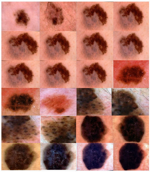 Detection of Skin Cancer Based on Skin Lesion Images Using Deep Learning