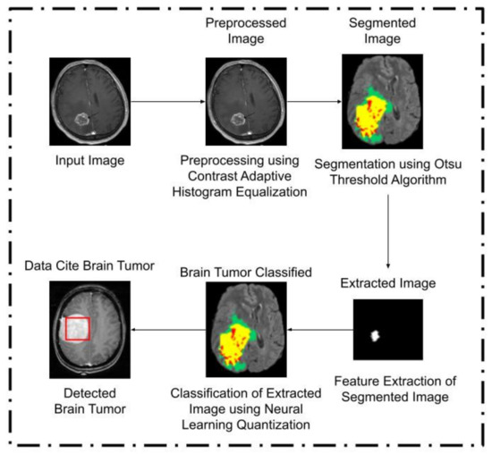 Earlier Detection Of Brain Tumor By Pre Processing Based On Histogram Equalization With Neural 