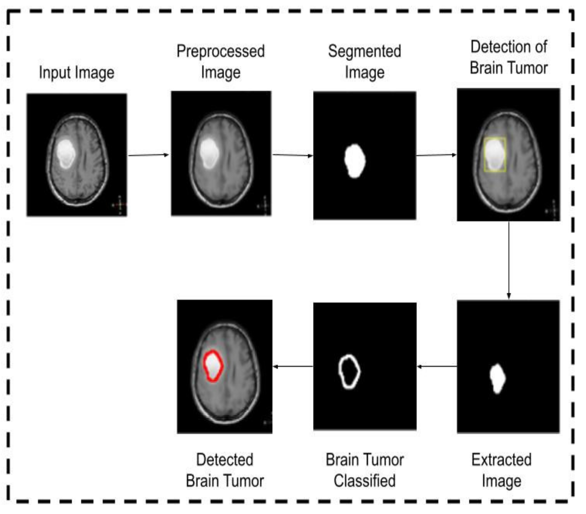 Healthcare | Free Full-Text | Earlier Detection of Brain Tumor by Pre ...