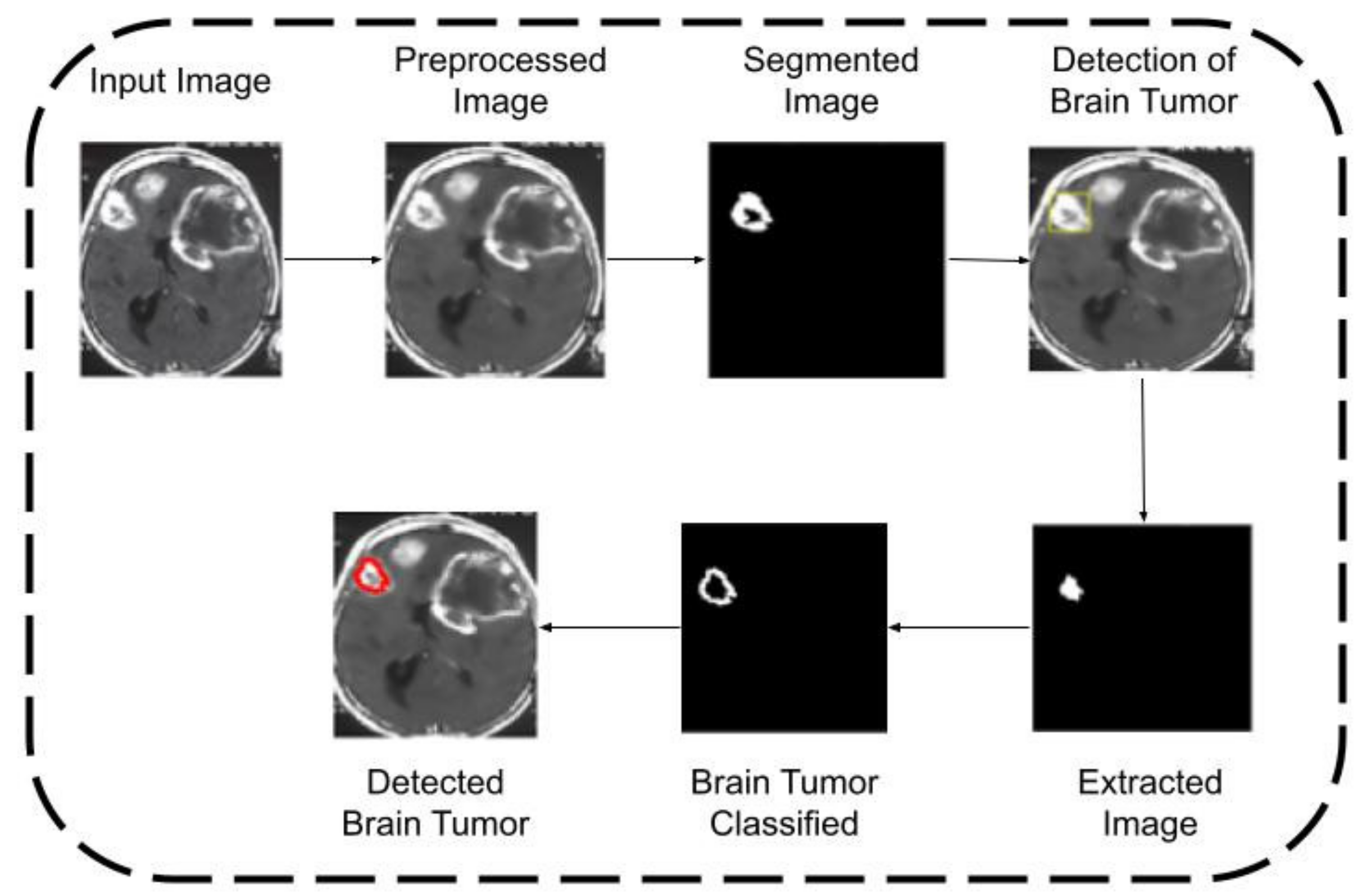 Earlier Detection of Brain Tumor by Pre-Processing Based on Histogram ...
