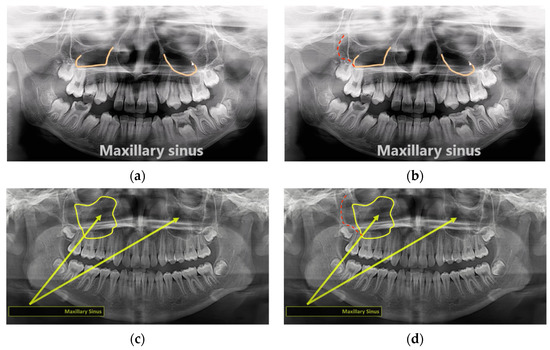 Content Analysis of YouTube Videos on Radiographic Anatomy on Dental ...