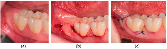 Periodontal Healing after Lower Third Molars Extraction: A Clinical ...
