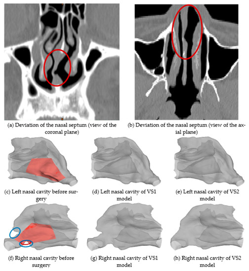 Septoplasty Effect on the Enhancement of Airflow Distribution and ...