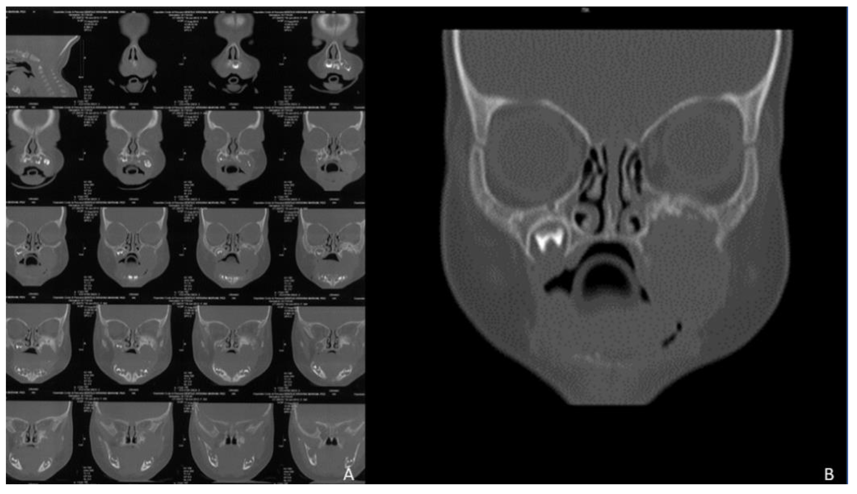 Early Class III Treatment Using a Hybrid Rapid Palatal Expander and ...