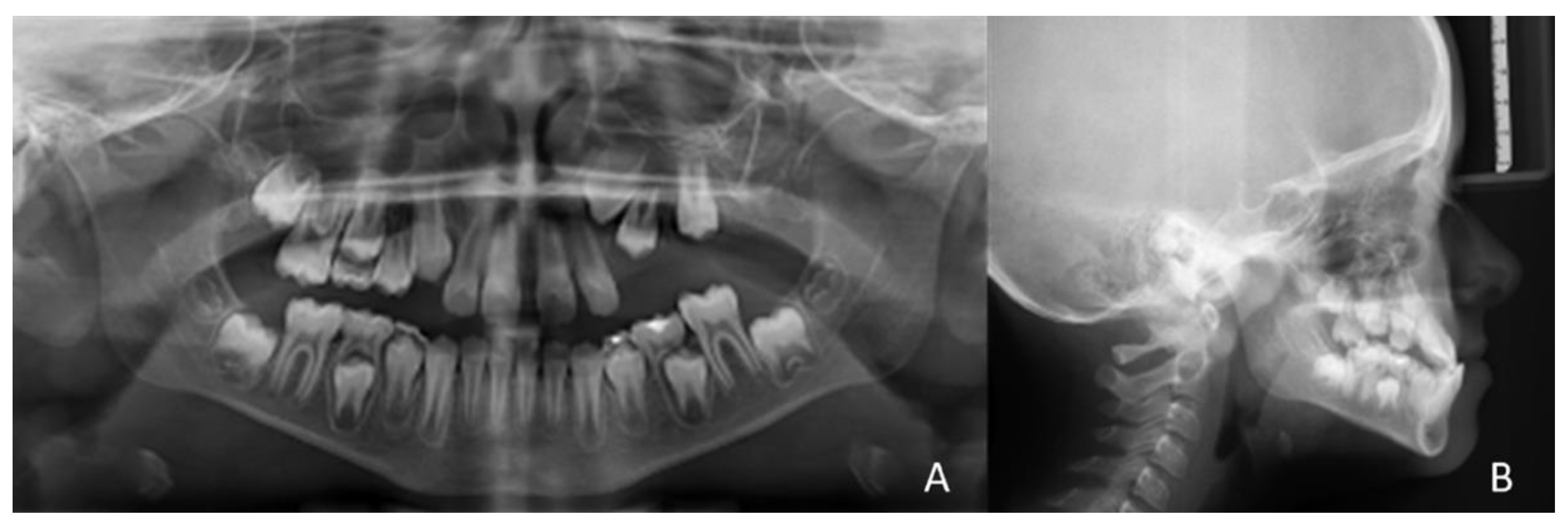 Early Class III Treatment Using a Hybrid Rapid Palatal Expander and ...