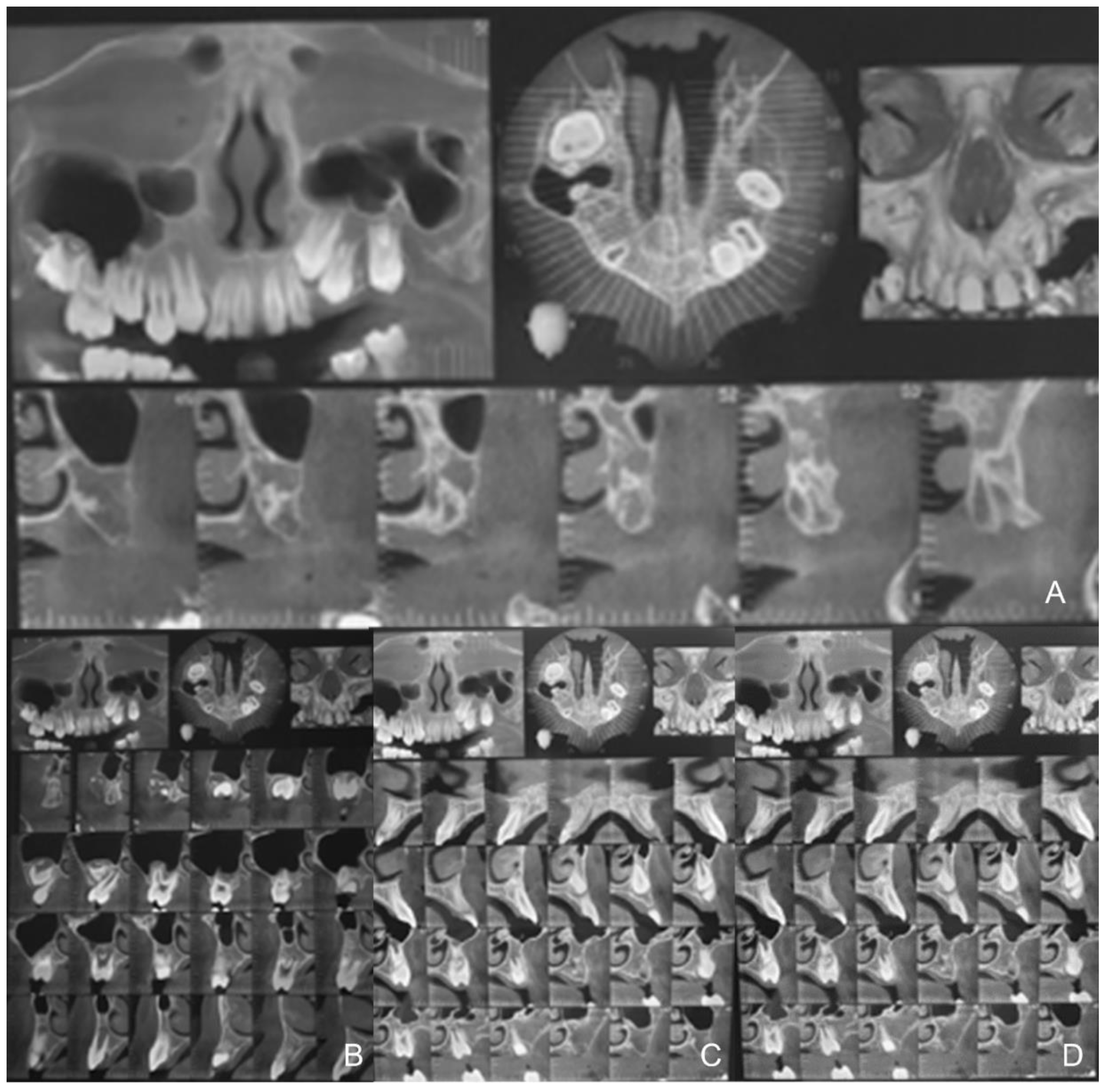Early Class III Treatment Using a Hybrid Rapid Palatal Expander and ...