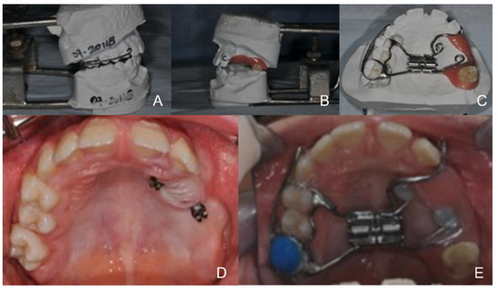 Early Class III Treatment Using a Hybrid Rapid Palatal Expander and ...