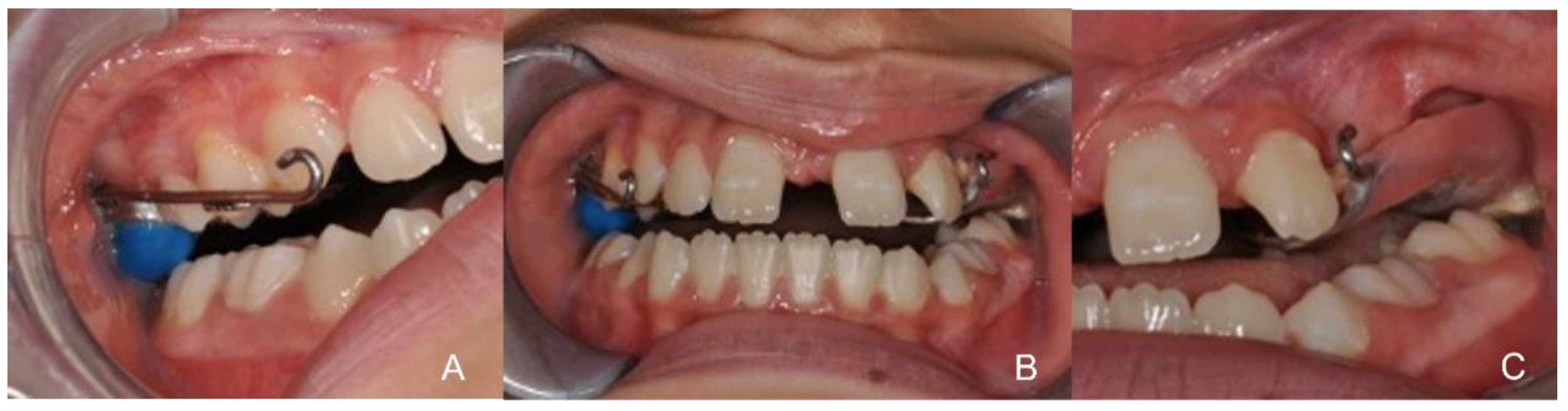 Early Class III Treatment Using a Hybrid Rapid Palatal Expander and ...