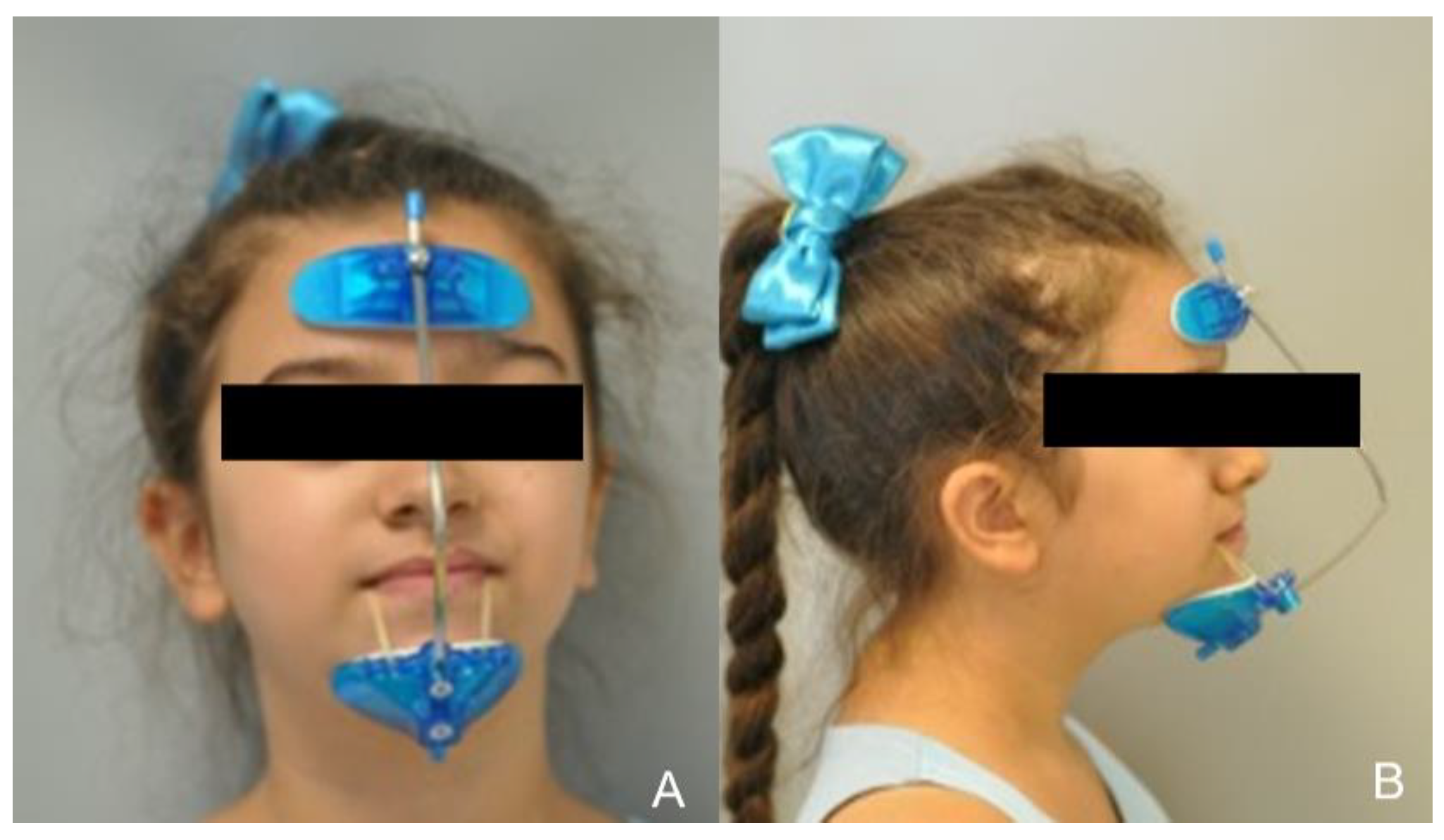 Early Class III Treatment Using a Hybrid Rapid Palatal Expander and ...