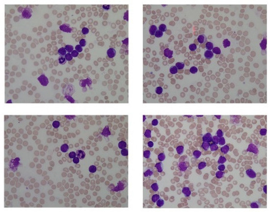 Customized Deep Learning Classifier for Detection of Acute ...