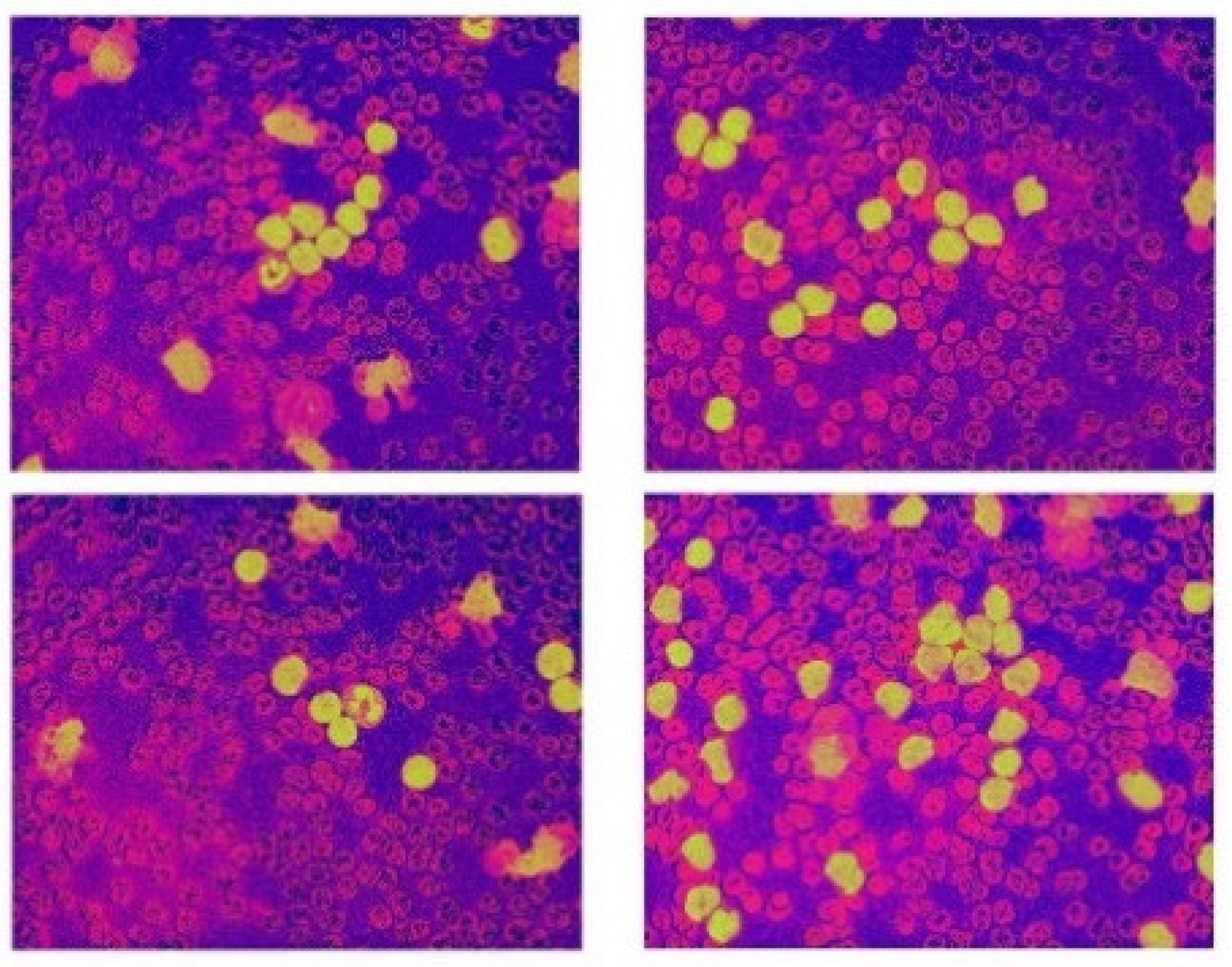 Customized Deep Learning Classifier for Detection of Acute Lymphoblastic Leukemia Using Blood ...