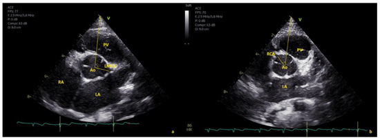 Screening of Coronary Artery Origin by Echocardiography: Definition of ...