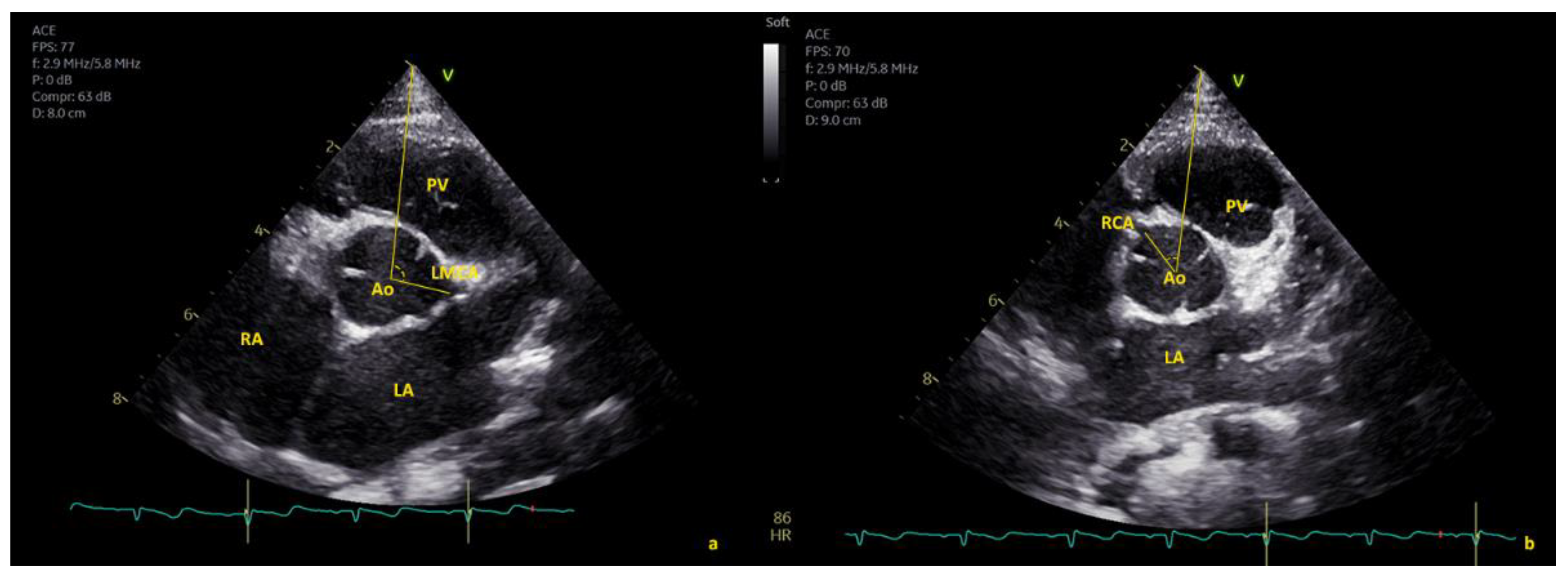 Screening of Coronary Artery Origin by Echocardiography: Definition of Normal (and Abnormal ...