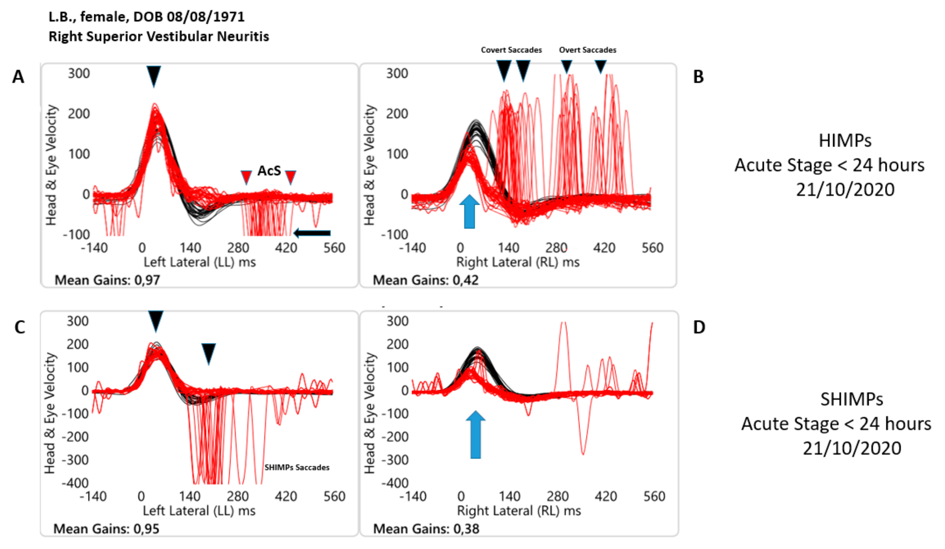 Video Suppression Head Impulses and Head Impulses Paradigms in Patients ...
