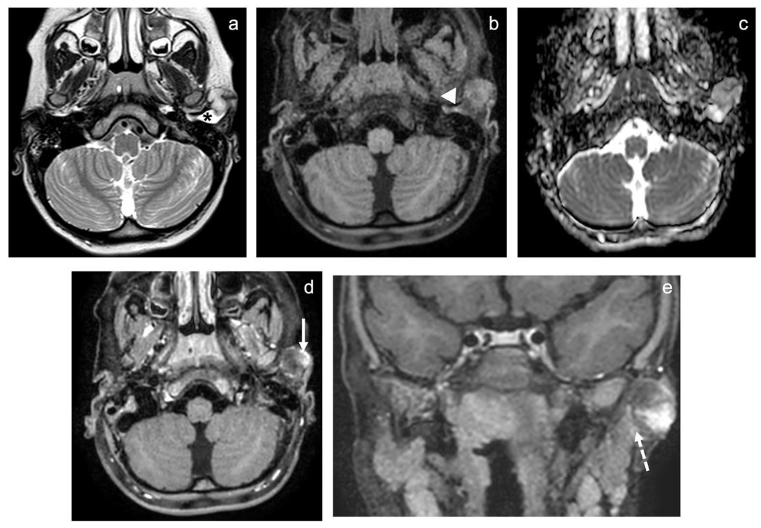 Diagnosis and Treatment of Nodular Fasciitis of Ear Region in Children ...