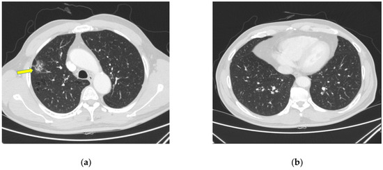 Pneumocystis Pneumonia in a Non-Immunocompromised Lung Cancer Patient ...
