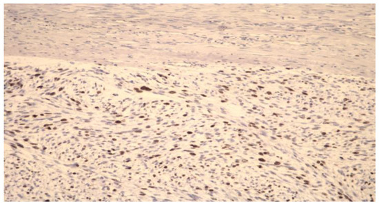 Fibroid Removal after Myomectomy: An Overview on the Problems of Power ...