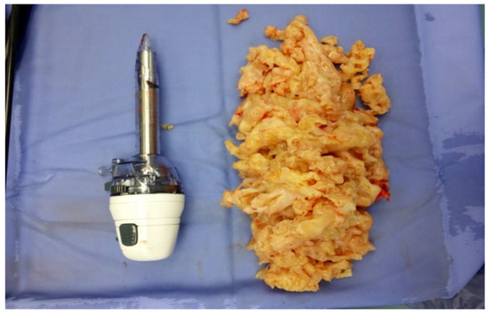 Fibroid Removal after Myomectomy: An Overview on the Problems of Power ...