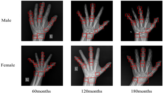 Healthcare | Free Full-Text | Automated Bone Age Assessment: A New Three-Stage Assessment Method ...