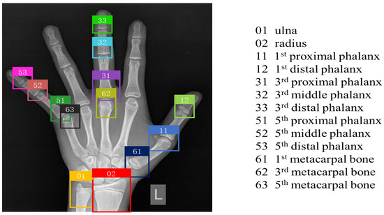 Automated Bone Age Assessment: A New Three-Stage Assessment Method from ...