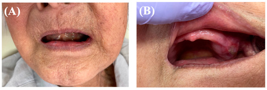 A Case of Oral Health Management for a Patient with Extensive ...