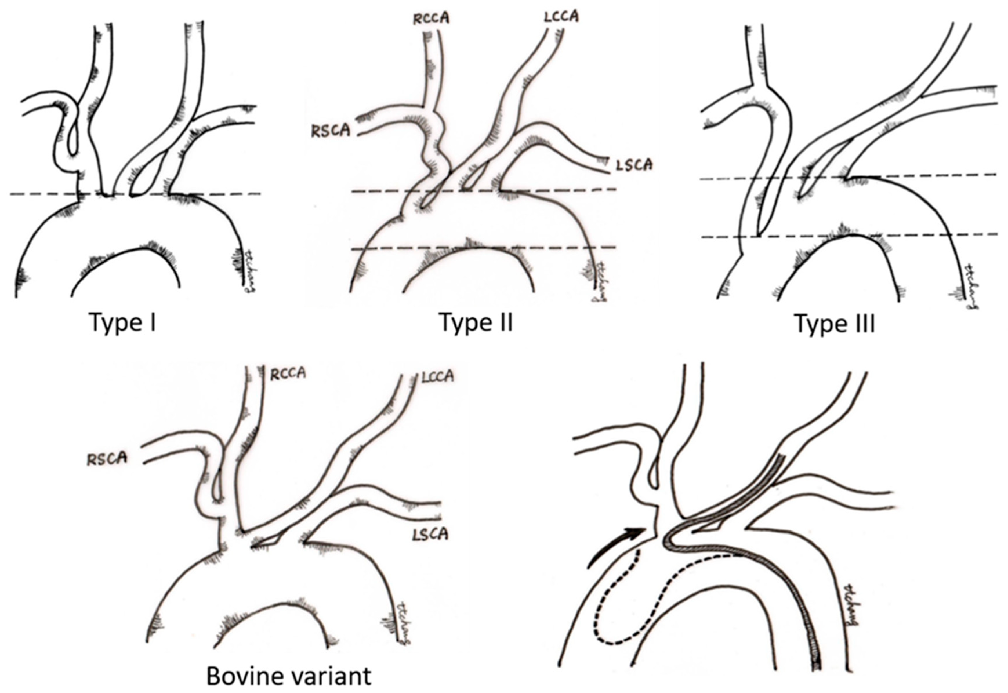 Patient-Specific 3D-Print Extracranial Vascular Simulators and Infrared ...