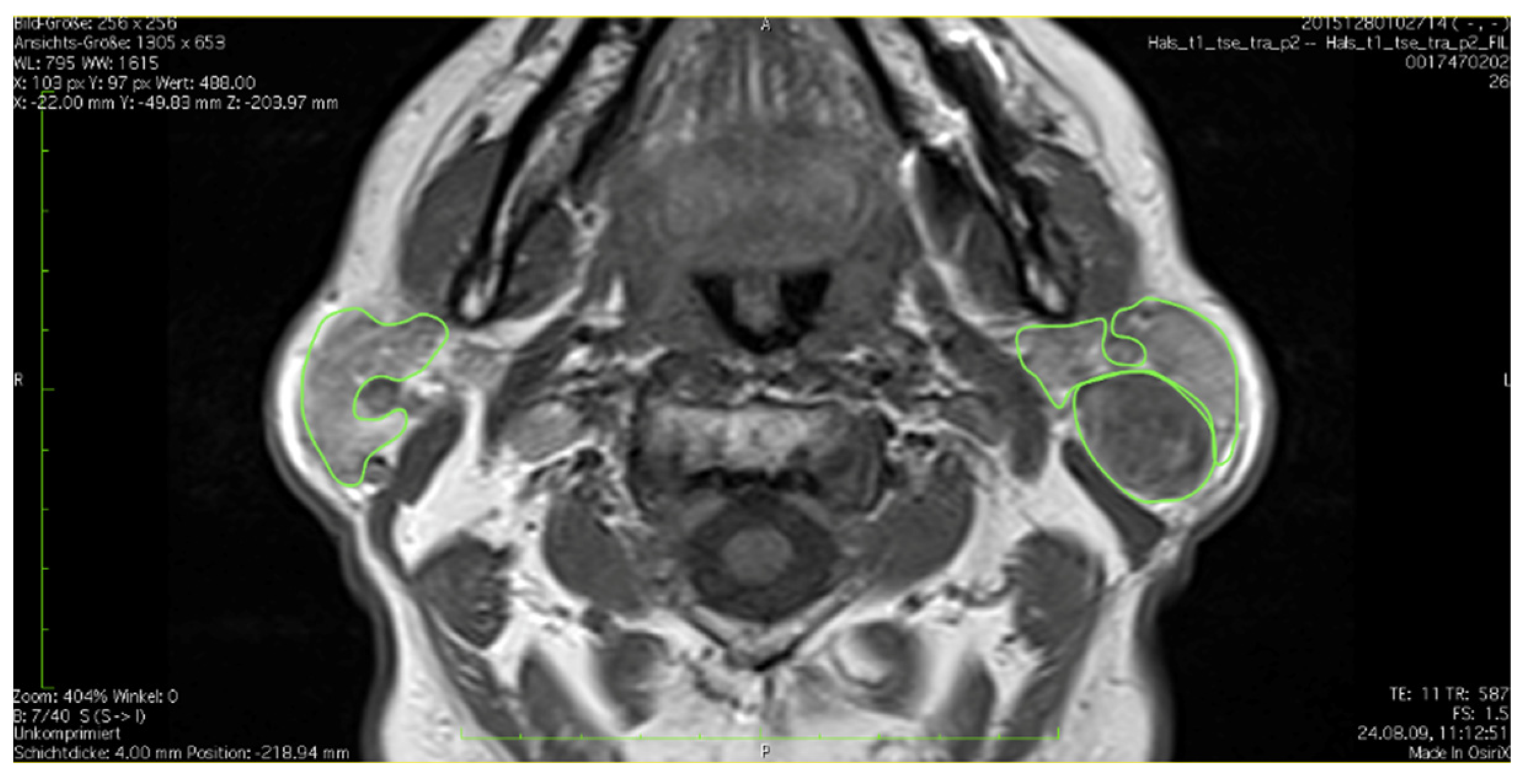 Population Based Average Parotid Gland Volume and Prevalence of ...