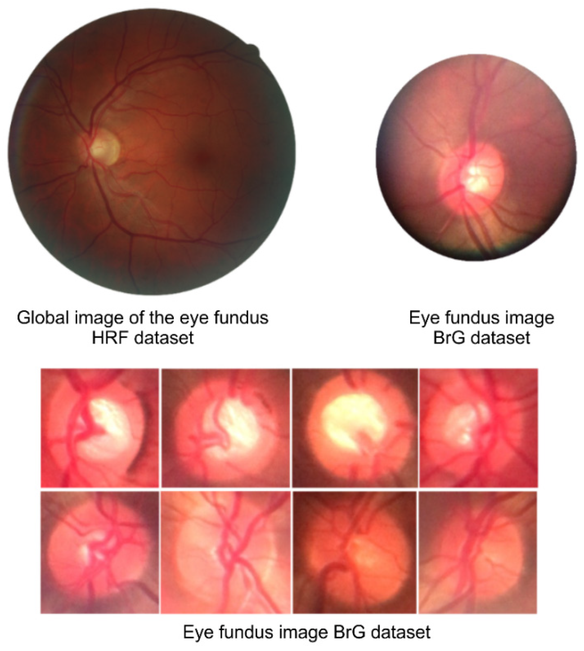 Glaucoma Fundus Glaucoma Fundus