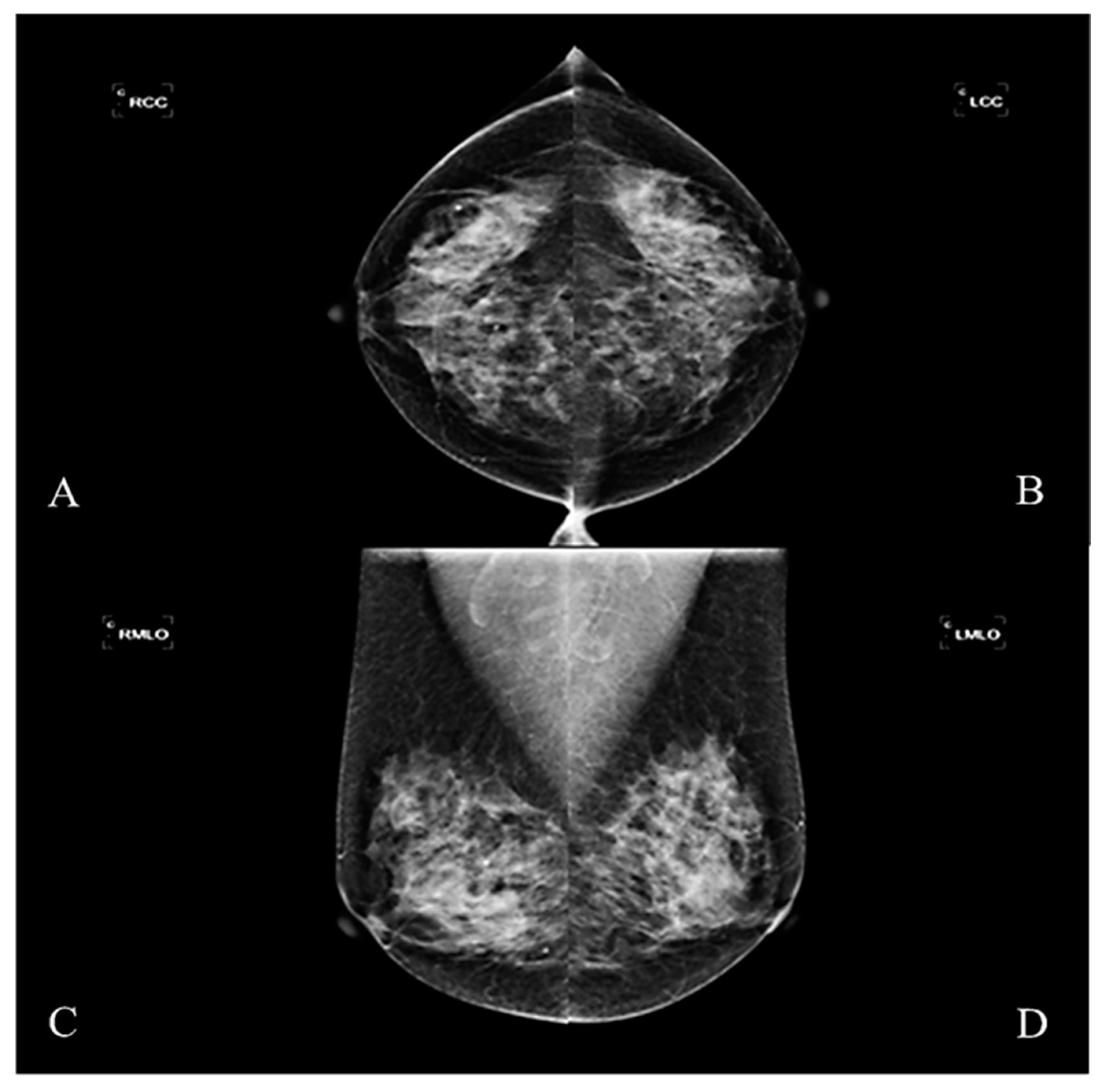 Using Deep Neural Network Approach for Multiple-Class Assessment of Digital Mammography