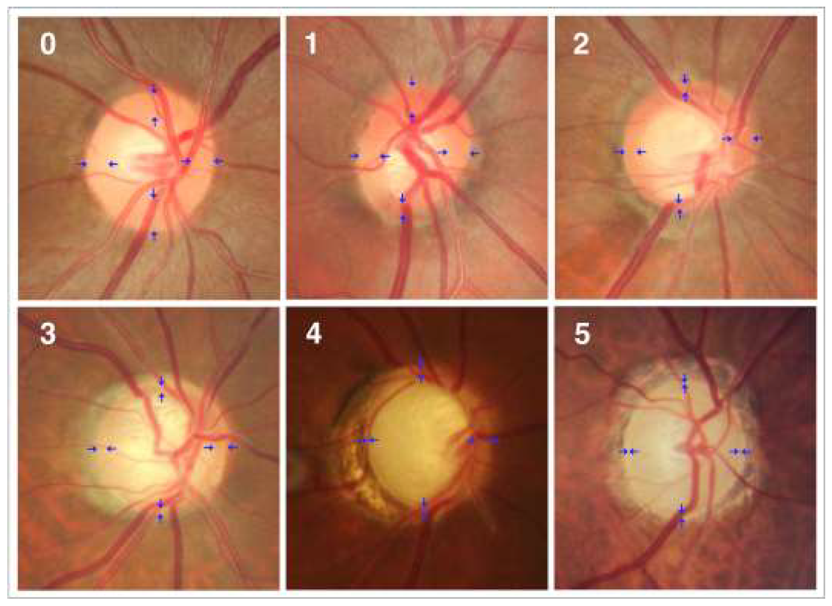 Glaucoma Detection And Classification Using Improved U Net Deep Learning Model