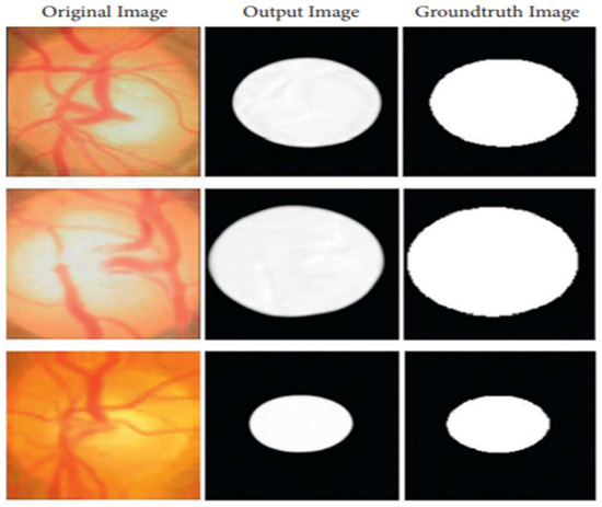 Glaucoma Detection and Classification Using Improved U-Net Deep Learning Model