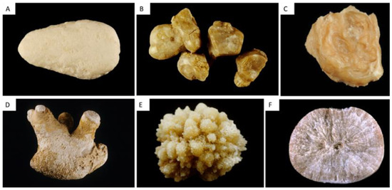 Description of Stone Morphology and Crystalluria Improve Diagnosis and ...