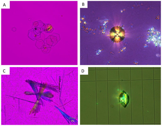 Description of Stone Morphology and Crystalluria Improve Diagnosis and ...