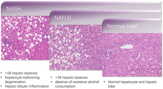 Artificial Intelligence in NAFLD: Will Liver Biopsy Still Be Necessary ...