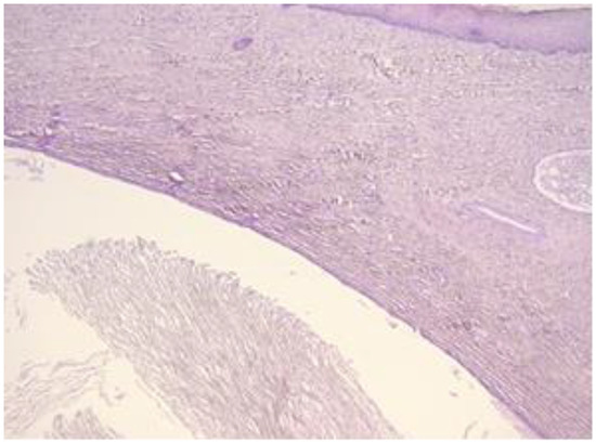 Epidermoid Cyst of the Uterine Cervix, an Unusual Location: Literature ...