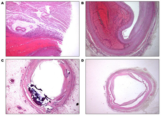 Extended Stanford Type-A Aortic Dissection with Multivessel Coronary ...