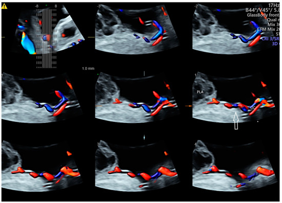 Application of Color Doppler with 3- and 4-Dimensional Ultrasonography ...