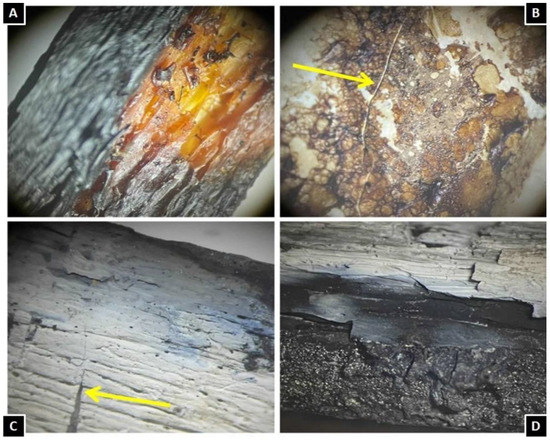 Useful Evidence by Post-Mortem CT and Stereomicroscopy in Bone Injury ...