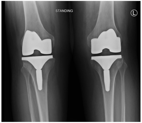 Management of Bilateral Quadriceps Tendon Ruptures Post Total Knee ...