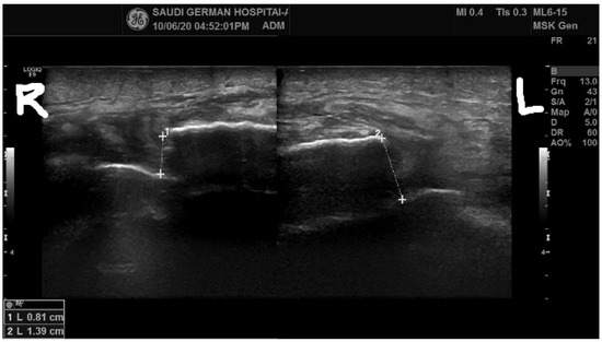 Management of Bilateral Quadriceps Tendon Ruptures Post Total Knee ...