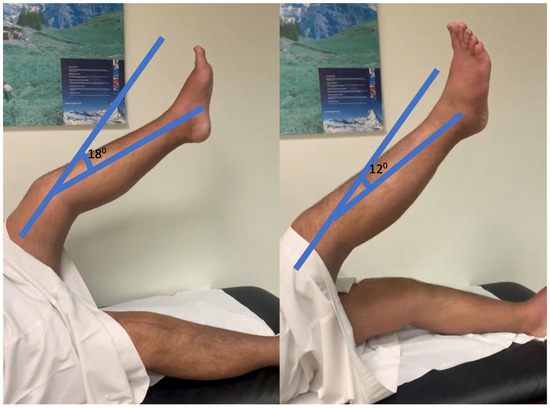 Management of Bilateral Quadriceps Tendon Ruptures Post Total Knee ...