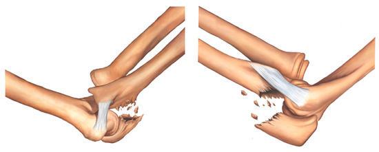 Morphological Characteristics of Proximal Ulna Fractures: A Proposal ...