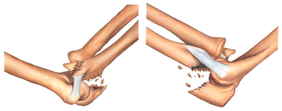 Morphological Characteristics of Proximal Ulna Fractures: A Proposal ...