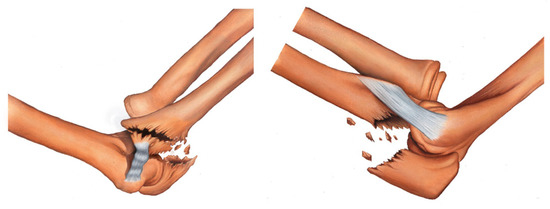 Morphological Characteristics of Proximal Ulna Fractures: A Proposal ...