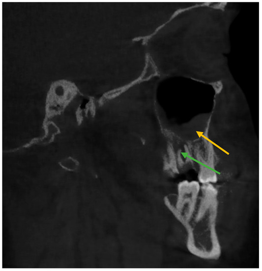 Healthcare | Free Full-Text | CBCT Evaluation of Periapical Pathologies ...