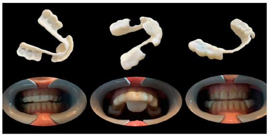 Full-Digital Workflow for TMDs Management: A Case Series