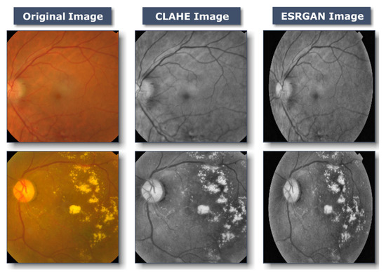 Deep Learning-Based Prediction of Diabetic Retinopathy Using CLAHE and ...