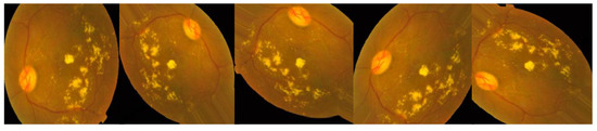 Deep Learning-Based Prediction of Diabetic Retinopathy Using CLAHE and ...