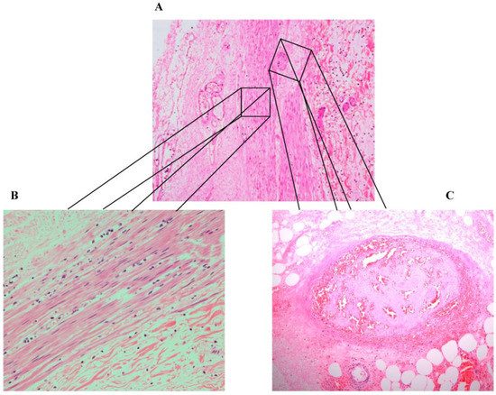 Fatal Case of a Child Harboring Enterobius vermicularis
